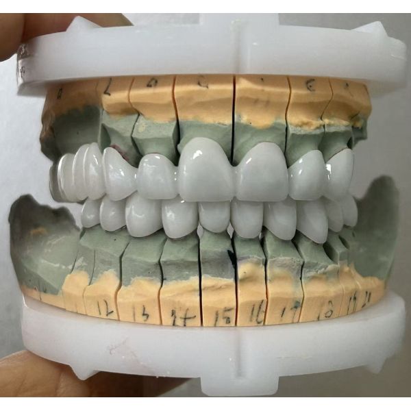 Quality Full Zirconia dental bridge for high strength and durable dental restoration for sale