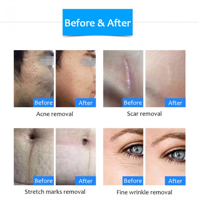 RF Beauty Equipment Gold RF Micro Needle For Wrinkle Removal Skin Tightening 1