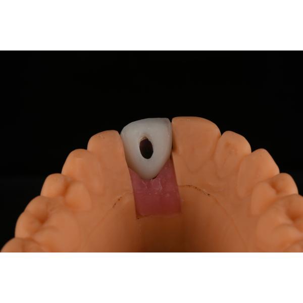 Quality Roughened Surface Titanium Dental Implants Surgery For Front Tooth Replacement for sale