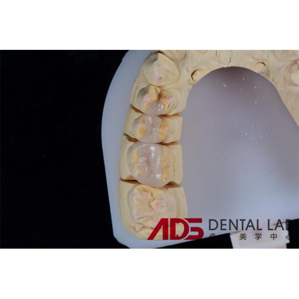 Quality Seamless Porcelain Emax Veneers Teeth Replacement Authentic Looking for sale