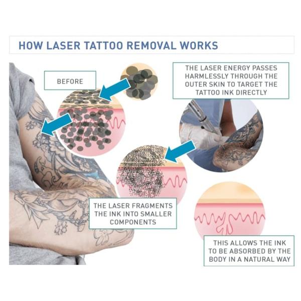Quality 755nm 1064nm Picosecond Tattoo Removal Machine 500ps Nd Yag Laser for sale