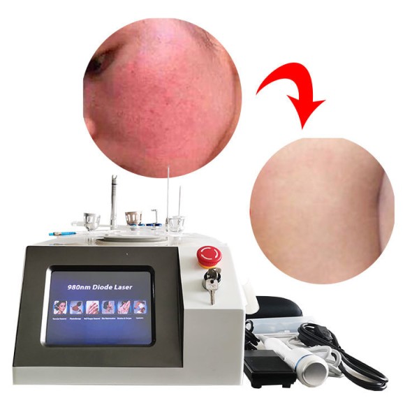 Quality 6 In 1 Spider Vein Laser Machine , 980nm Face Vascular Treatment Varicose Veins Machine for sale
