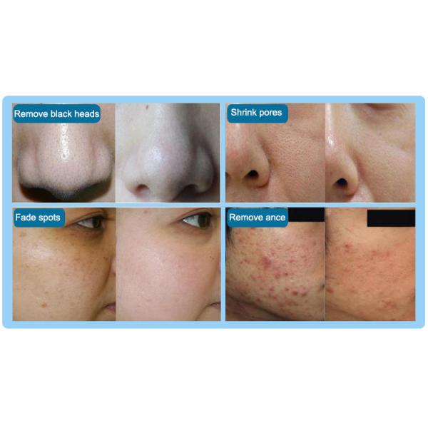 Quality 4 Tips Dermabrasion Diamond Peel Hydro Facial Machines for sale