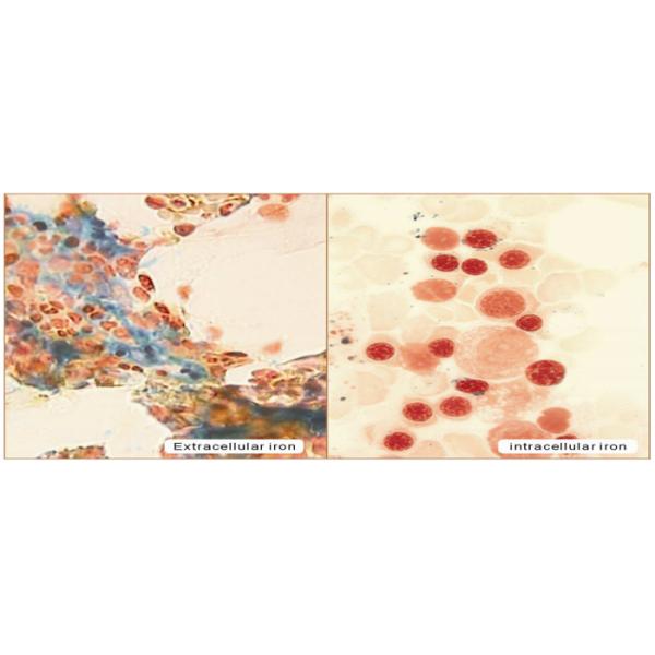 Quality 5Tests 20Tests 100Tests Iron Stain Kit For Staining Bone Marrow Cell And for sale
