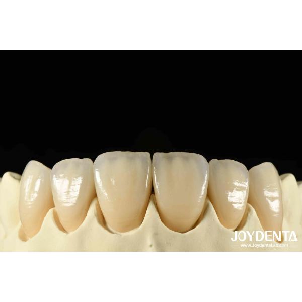 Quality Bionic Development Leaves And Distinct Layers Of Zirconia All-Ceramic for sale