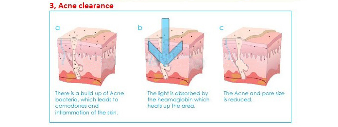 portable IPL hair removal machine/ IPL machine/ portable IPL