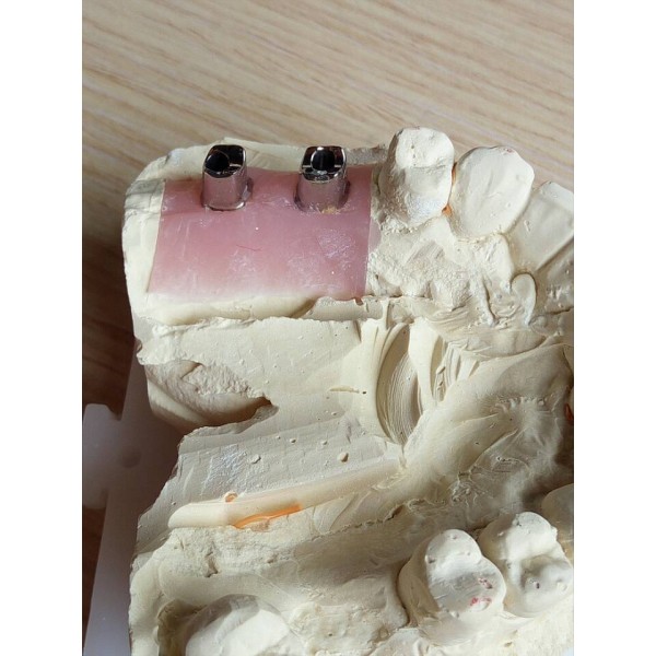 Quality Custom-made Biocompatible Titanium Abutment with High Durability for Dental Implants for sale