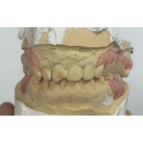 Quality Removable Denture with Lingual Bar Retention for High Precision Fit and Conservative Tooth Preservation for sale