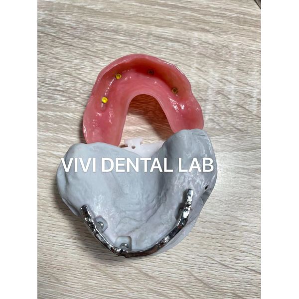 Ivoclar Digital Dental Implant Bar Denture With Attachments from China ...