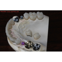 Quality Porcelain Dental Crown Tooth-Shaped Cap for Restoring Shape and Enhancing for sale