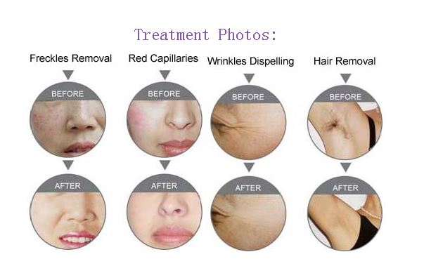 Ipl Shr Elight Machine For Hair Removal And Skin Rejuvenation