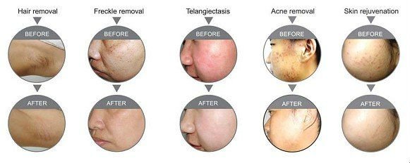 IPL before and after pictures.jpg