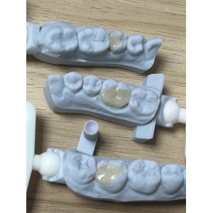 Quality Dental Inlay/ Onlay for sale