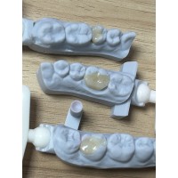 Quality Dental Inlay Tooth Restoration with CAD/CAM Digital Technology High Fracture for sale