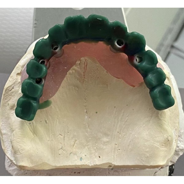 Quality High Precision Implant Supported Crown Stable And Easy Maintenance for sale