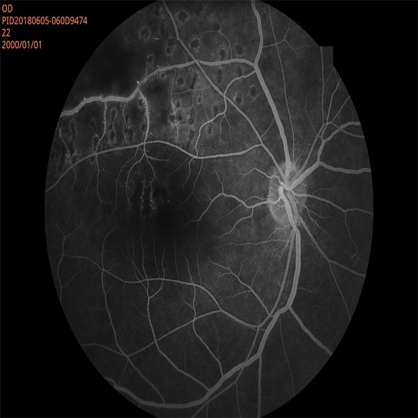 Quality High Resolution Automated Fundus Camera with FFA or FAF, mosaic function for sale