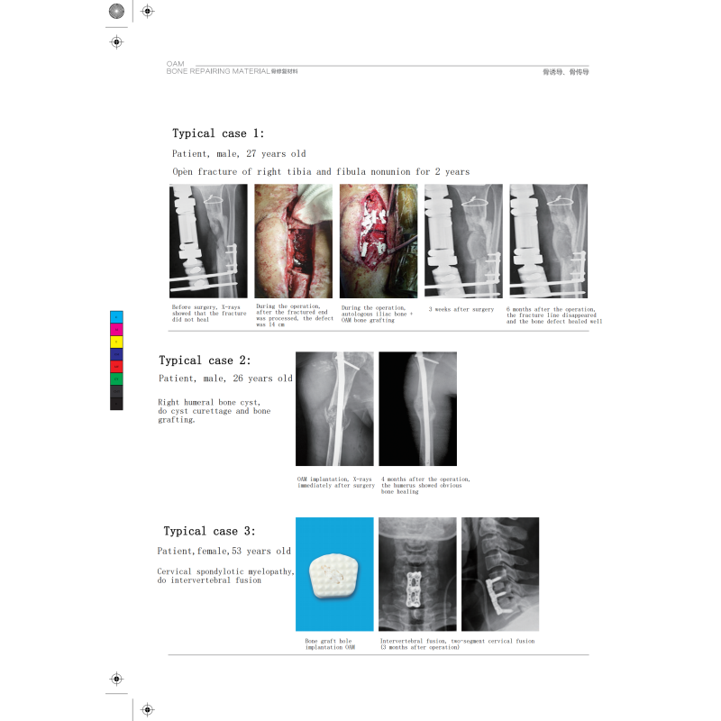 2g Bone Dfect Substitute Trauma Spine Osteoinductive Activity Graft
