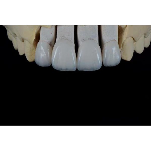 Quality Handcrafted Porcelain Feldspathic Dental Veneer Natural Looking for sale