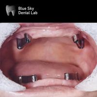 Quality Resin Teeth Dental Titanium Bar Removable Blue Sky Implant System for sale