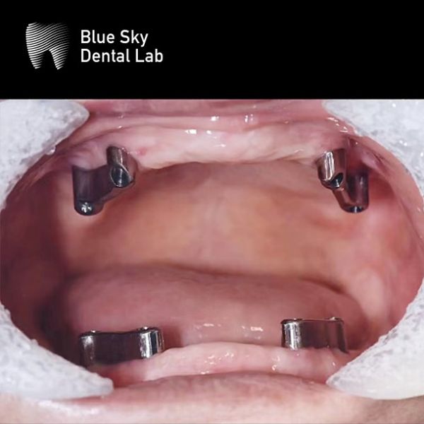 Quality Resin Teeth Dental Titanium Bar Removable Blue Sky Implant System for sale