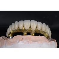 Quality Titanium Alloy Dental Implants And Crowns Natural Looking With Corrosion for sale