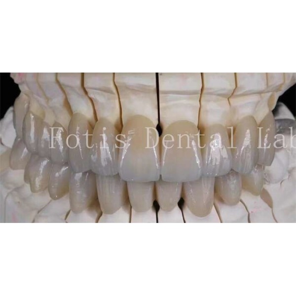 Quality Natural-Looking Smile Prosthetic Porcelain Laminate Veneers Smooth Surface for sale