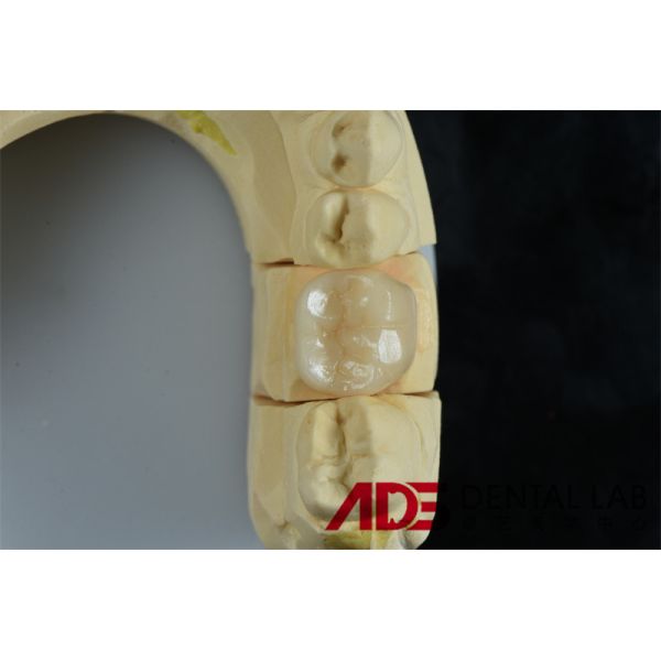Quality Seamless Porcelain Emax Veneers Teeth Replacement Authentic Looking for sale