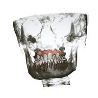 Quality Accurate Removable Orthodontic Appliance OEM Rapid Palatal Expander for sale
