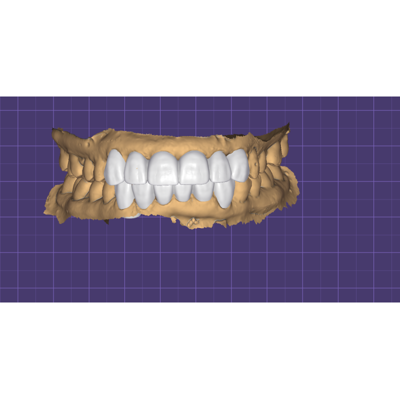 Quality Precision Fit Digital Wax Up Dental Study Model with Durable and Biocompatible for sale