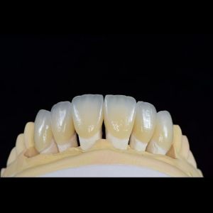 Quality Dental Lab Teeth Feldspathic Porcelain Veneers Custom Shaped for sale