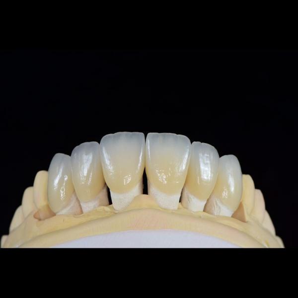 Quality Dental Lab Teeth Feldspathic Porcelain Veneers Custom Shaped for sale
