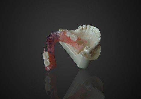 Valplast denture