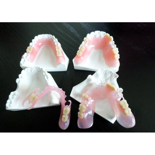 Quality Digital PFM Dental Crown Restoration for sale