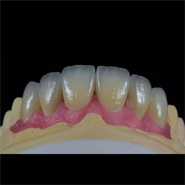 Quality Dental Lab Teeth Feldspathic Porcelain Veneers Custom Shaped for sale