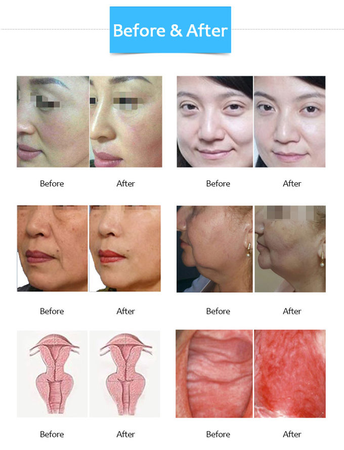 HIFU Beauty Machine Painless Treatment Vaginal Rejuvenation With Short Treatment Time