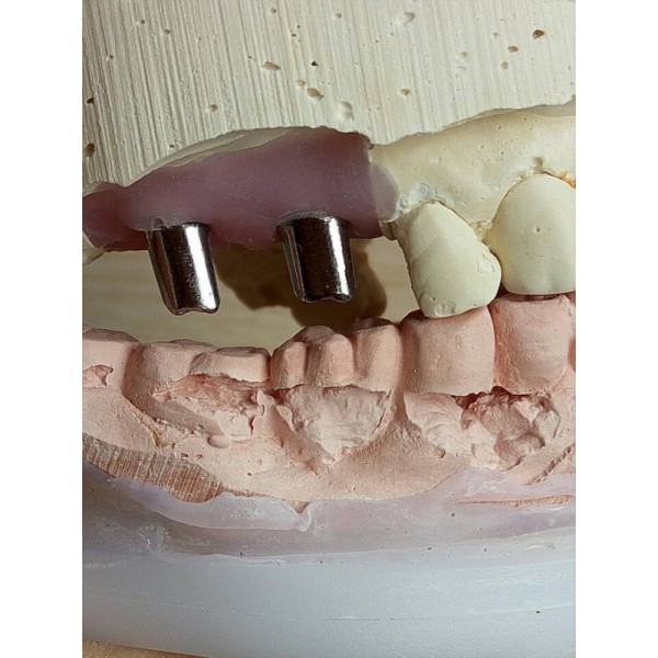 Quality Custom-made Biocompatible Titanium Abutment with High Durability for Dental for sale