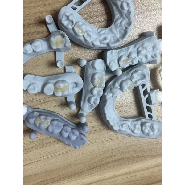 Quality Emax Inlay and Onlay Dental Restoration with Natural Teeth Color, Minimal Preparation, and High Translucency for sale