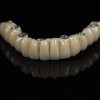 Quality All On 6 PFM Titanium Bridge Dental Crown Full Arch Implant for sale