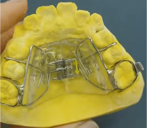 Quality Biocompatible and Clinically Proven Dental Expander - Custom-fitted Maxillary for sale