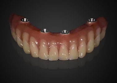 Implant restoration