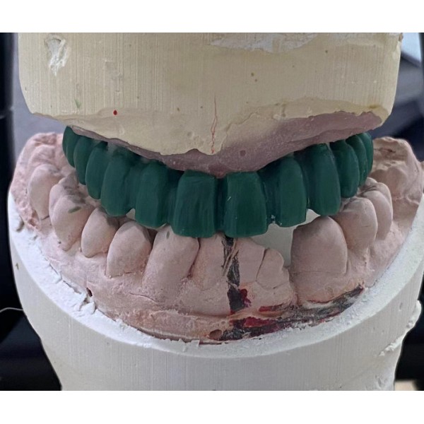 Quality High Precision Implant Supported Crown Stable And Easy Maintenance for sale