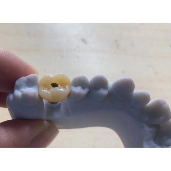Quality High Precision Implant Supported Crown Stable And Easy Maintenance for sale