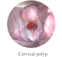 Mini Colposcope for Cervical Examintion Self - Exam Digital Electronic Colposcope BS1 Connected to TV