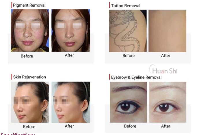 Picosecond Tattoo Removal Pigment Removal 1064nm 532nm 755nm Pico Laser