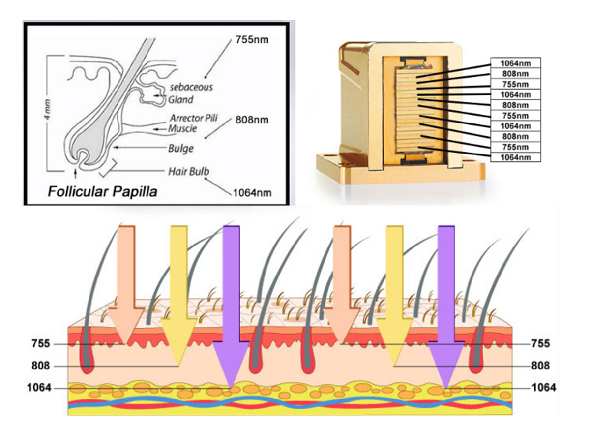Vertical Triple Wavelength Diode Laser Hair Removal System