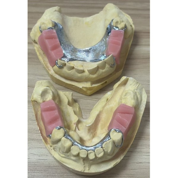 Quality Metal Framework with acrylic partial denture finish for sale