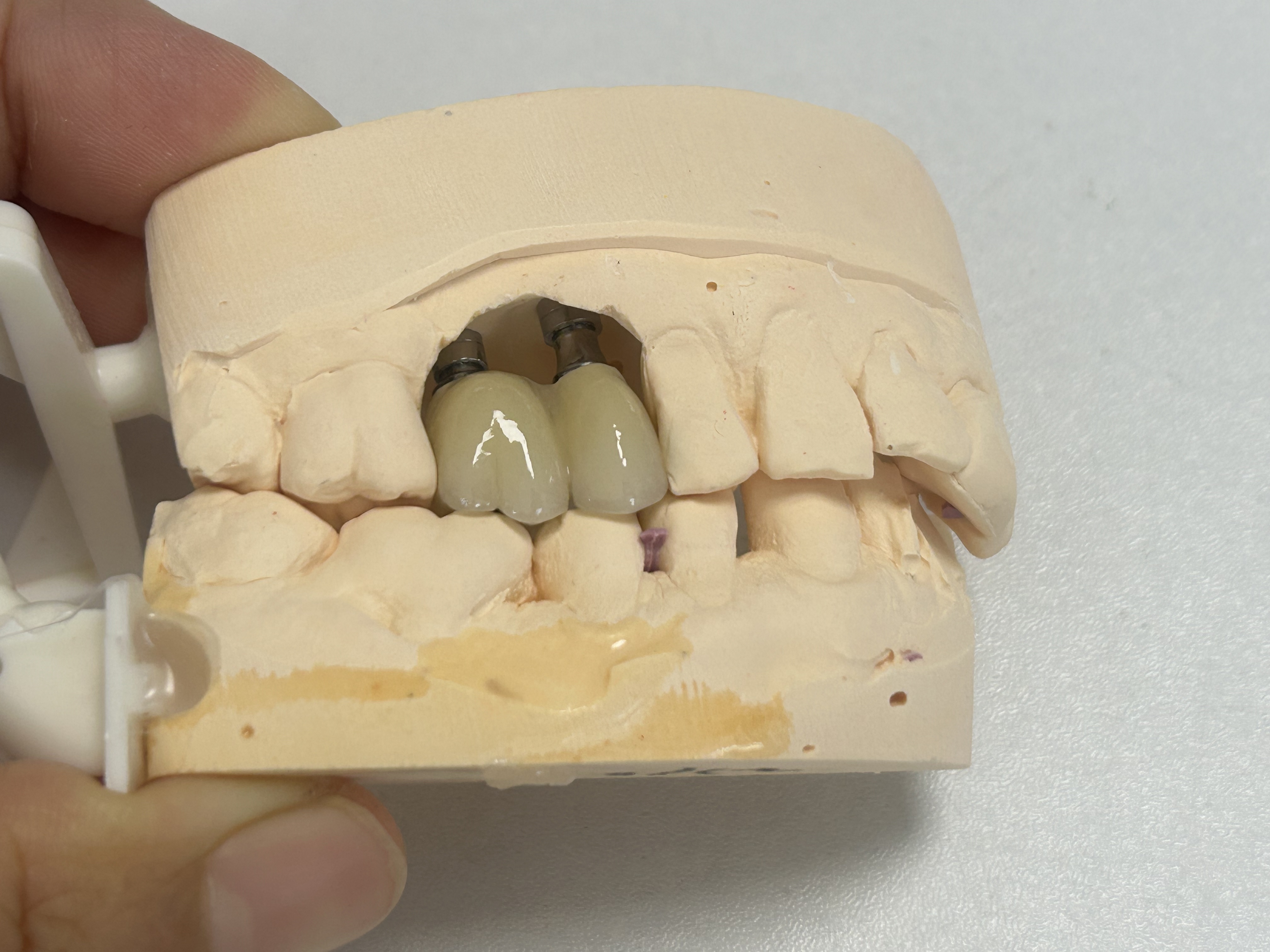 Quality China Dental Implant with Stable Fixation and Natural Appearance for Tooth Restoration for sale