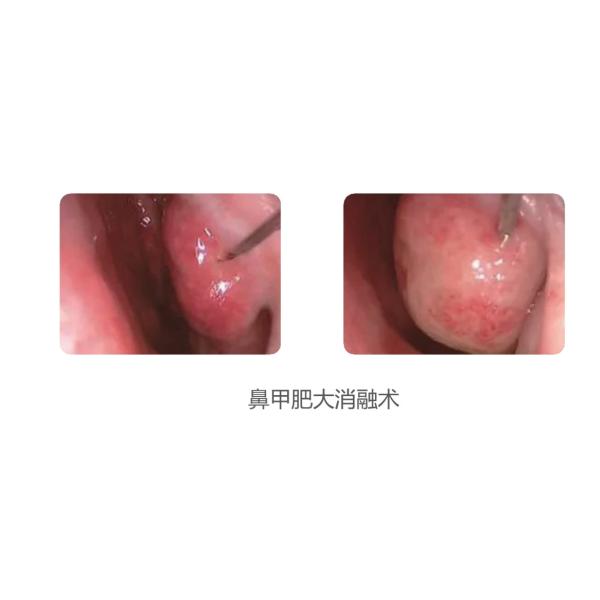 Quality Low Temperature RF Plasma System Cutting Perforation Ablation Cryosurgery Unit for sale