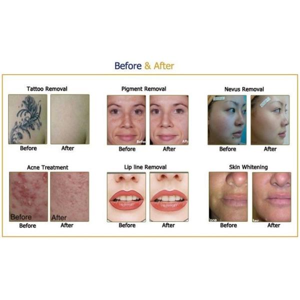Quality 7 Joints Laser Skin Rejuvenation Machine 500-800ps Nd Yag for sale