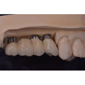 Quality Precision Fit Dental Implant Crowns Titanium / Zirconia / PFM Restoring Missing for sale